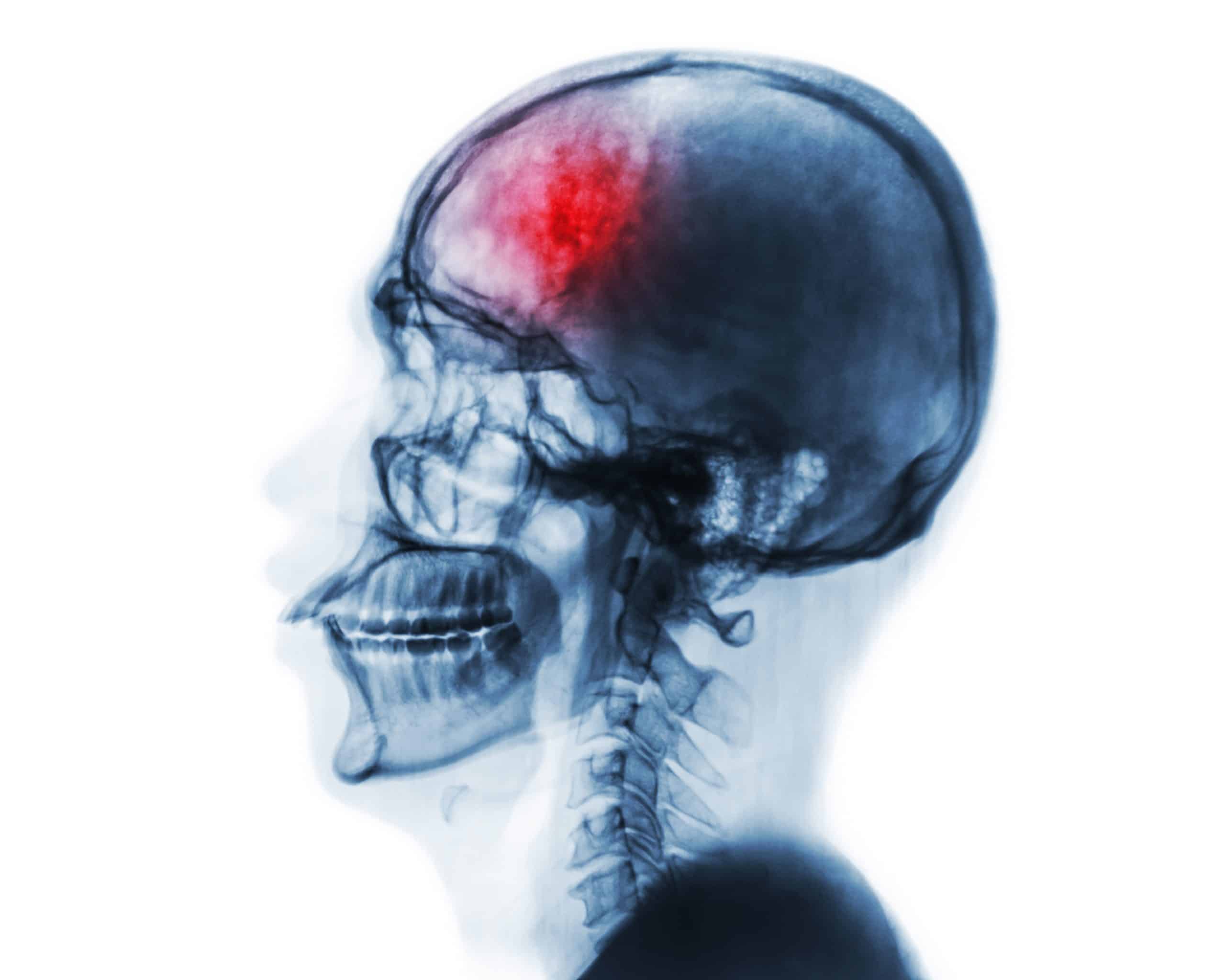 Post-Concussion Syndrome in Ontario: What Types of Treatments Are ...